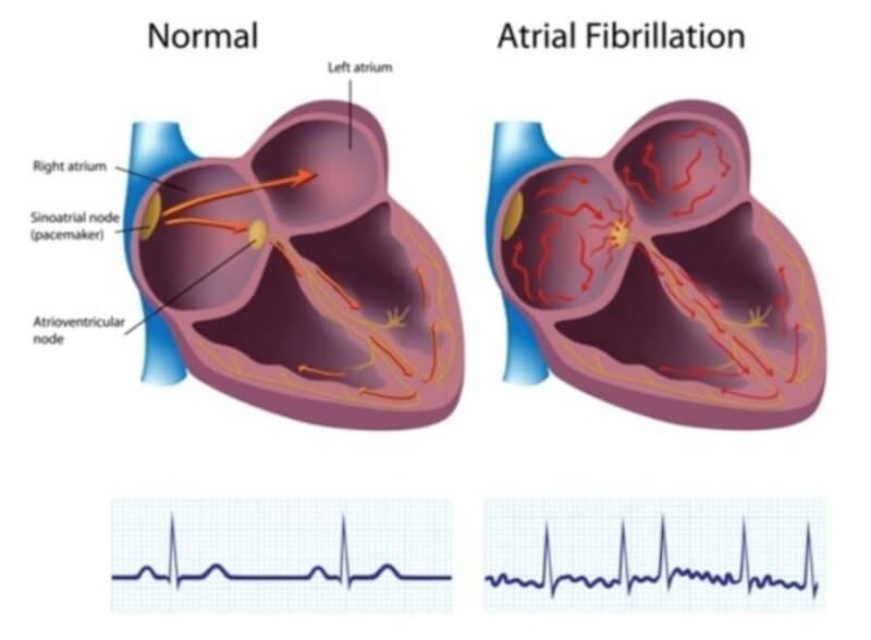 Apple Watch approved for AFib studies